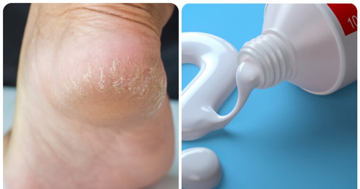 Hướng dẫn cách trị nứt gót chân bằng kem đánh răng hiệu quả