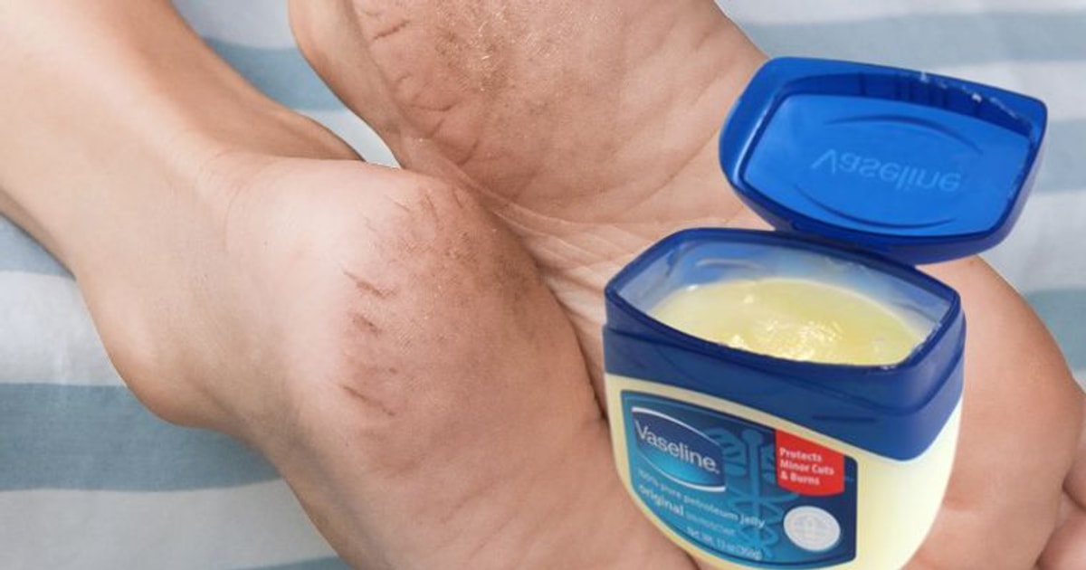 3 cách trị nứt gót chân bằng Vaseline hiệu quả ngay tại nhà