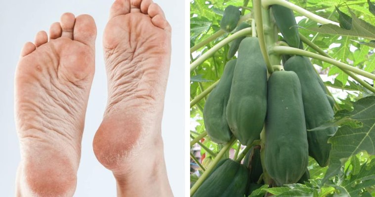 Cách trị nứt gót chân bằng nhựa đu đủ tại nhà hiệu quả